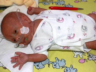Runjun Blog: World's Smallest Baby Boy Survives
